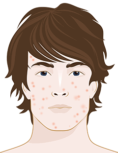 7 questions to the dermatologist about acne and blemished skin