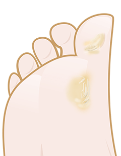 Itchy feet: Causes, treatment and prevention