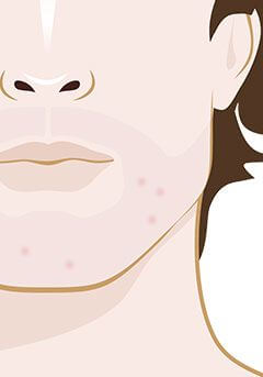 Treating razor burn and razor bumps → 5 steps you need to know