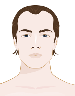 Bald spot on head - alopecia areata and its causes