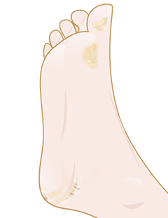 Put an end to dry feet - Complete guide