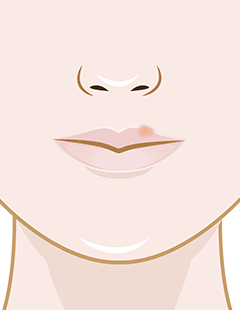 Spots on the lips – How to make them disappear